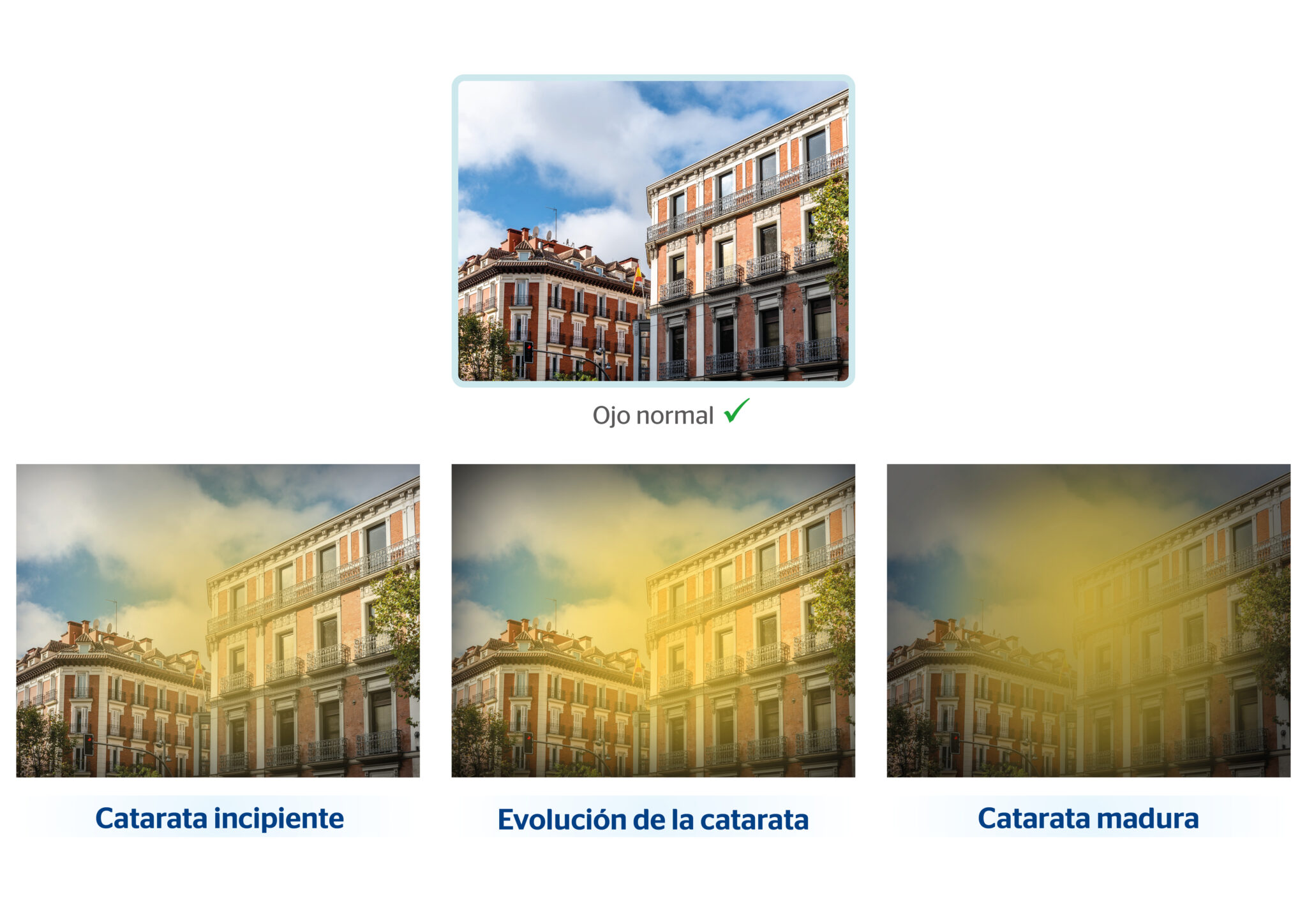 Catarata subcapsular posterior: ¿en qué consiste y cómo se corrige ...