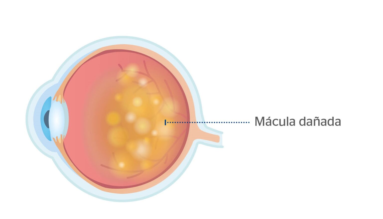 Distrofia macular: causas y tratamiento - Blog de Clínica Baviera