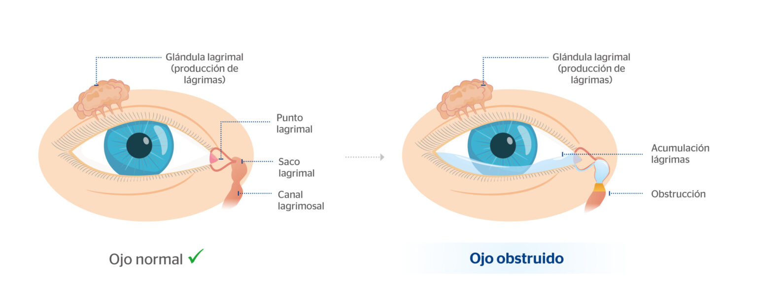 Párpados y ojos hinchados: causa hinchazón superior/inferior | Blog de ...