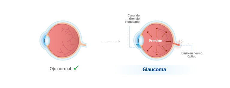Cuidados Postoperatorios de operación de glaucoma | Blog de Clínica Baviera