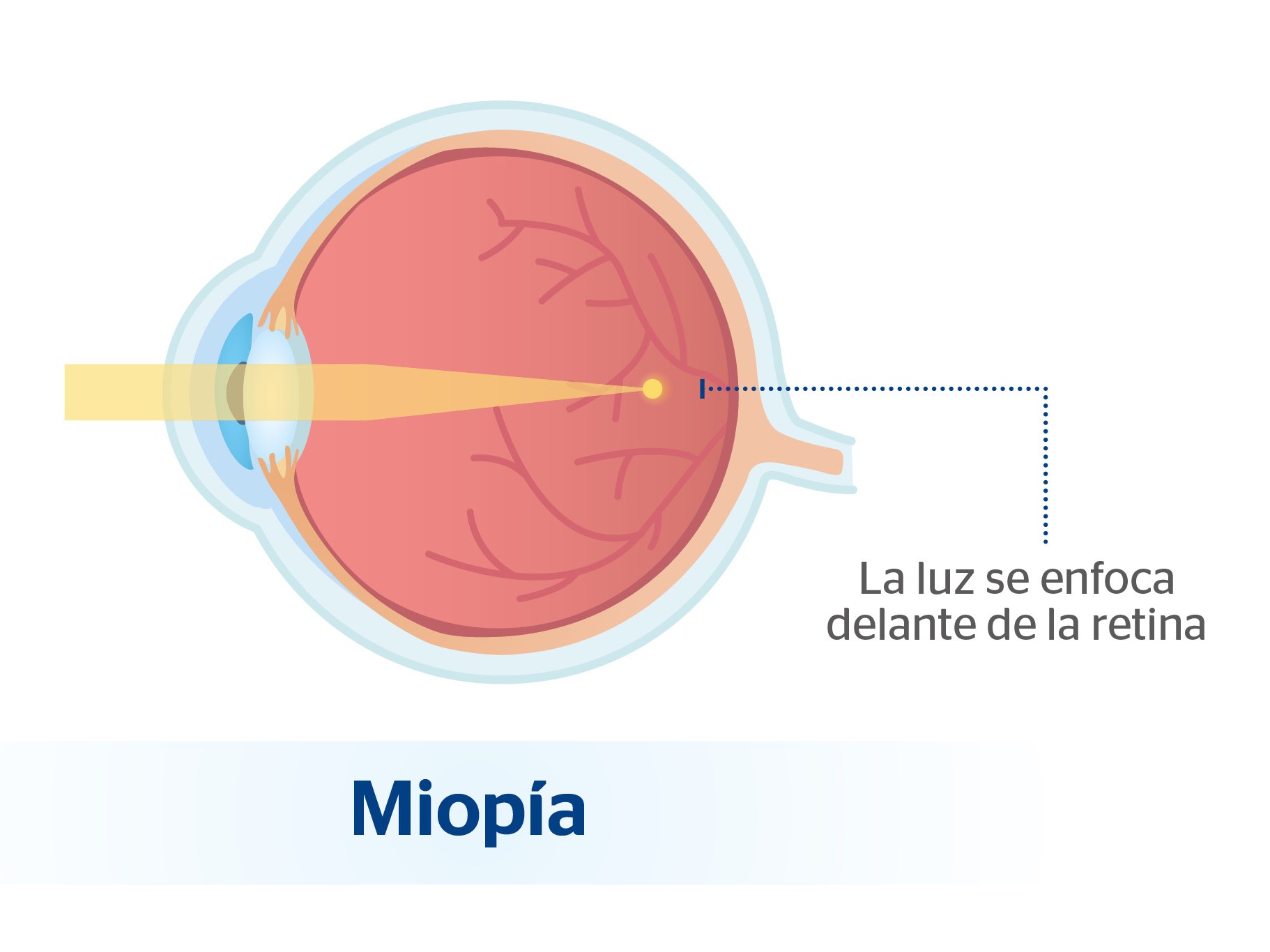 Ametropía ¿qué Es Y Qué Tipos Existen Ejercicio Para La Salud