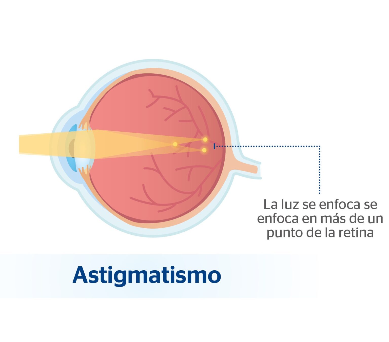 Ametropías Los Defectos De Refracción Que Nos Impiden Ver Bien