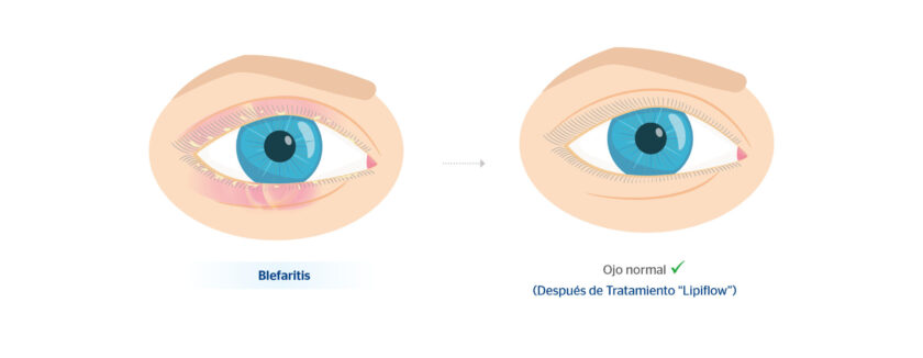 Blefaritis: ¿qué es y qué remedios caseros hay? | Blog de Clínica Baviera