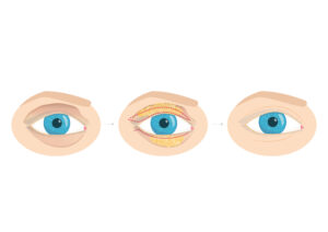Párpados y ojos hinchados: causas, tratamiento | Blog de Clínica Baviera