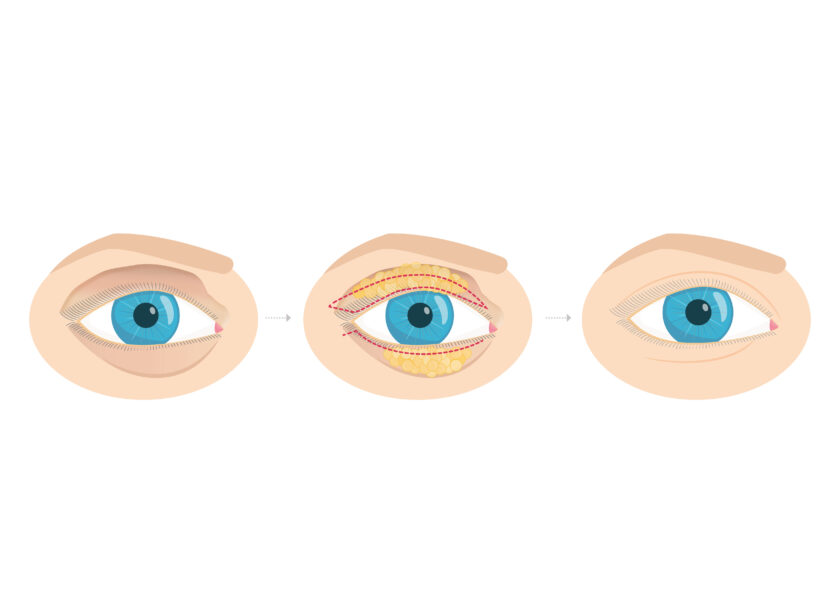 Párpados y ojos hinchados: causas, tratamiento | Blog de Clínica Baviera