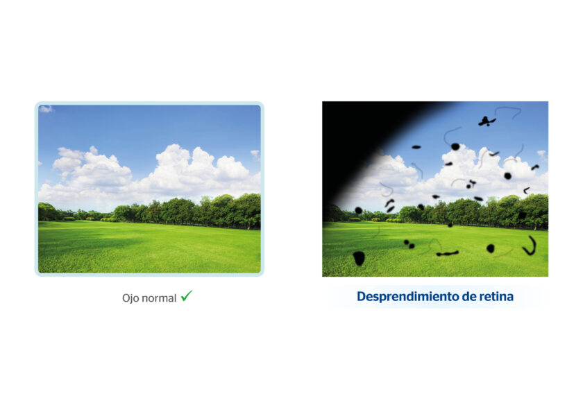 Destellos de luz en los ojos: por qué veo luces brillantes | Blog de ...