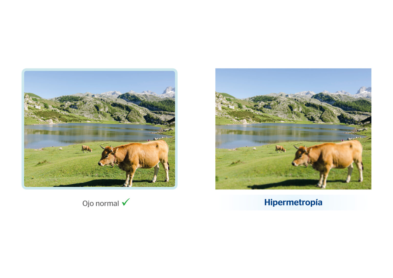 Descubre las diferencias entre hipermetropía y presbicia - Blog de ...