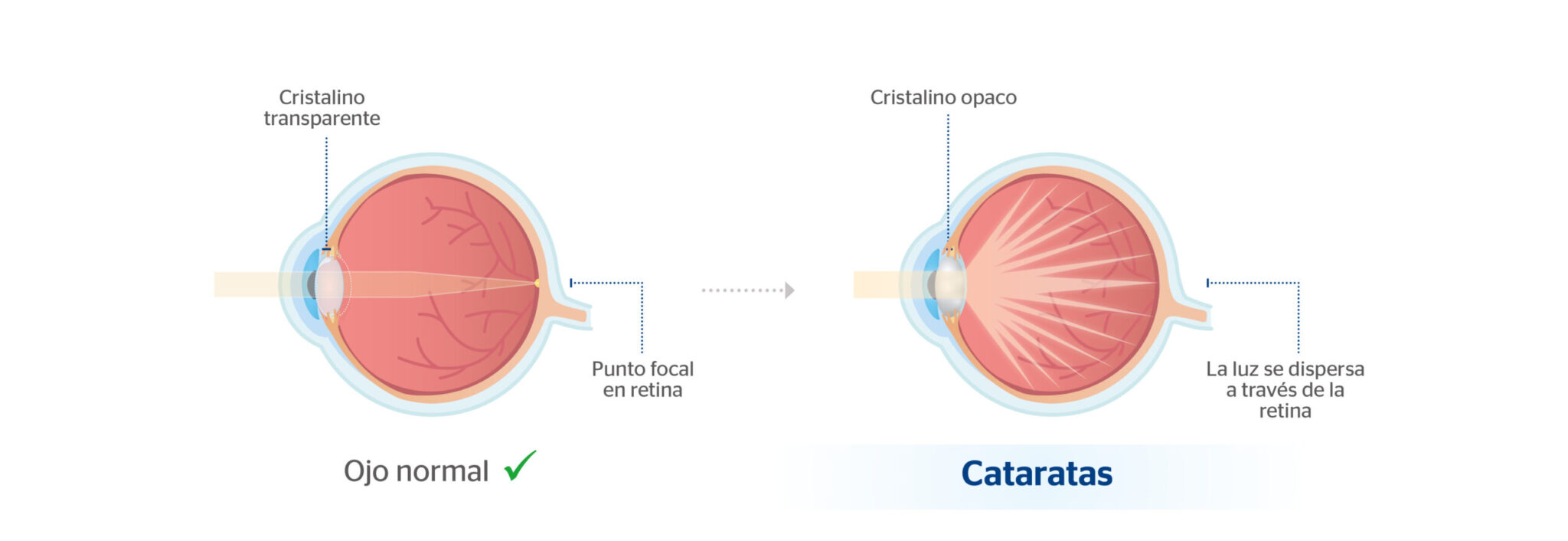 Operación de cataratas: ¿Seguridad Social o clínica privada? - Blog de ...