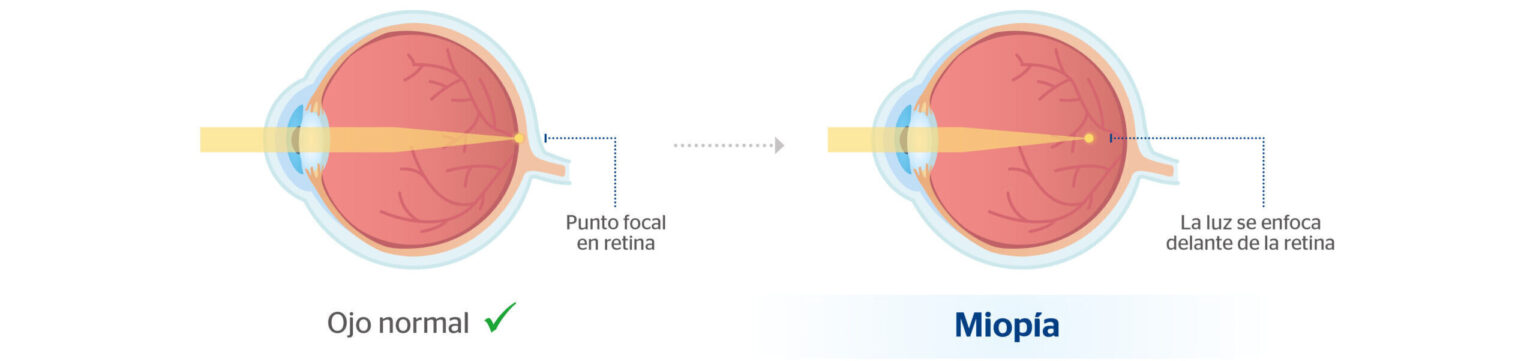 Visión borrosa en un ojo (o en ambos): ¿las causas? | Blog de Clínica ...