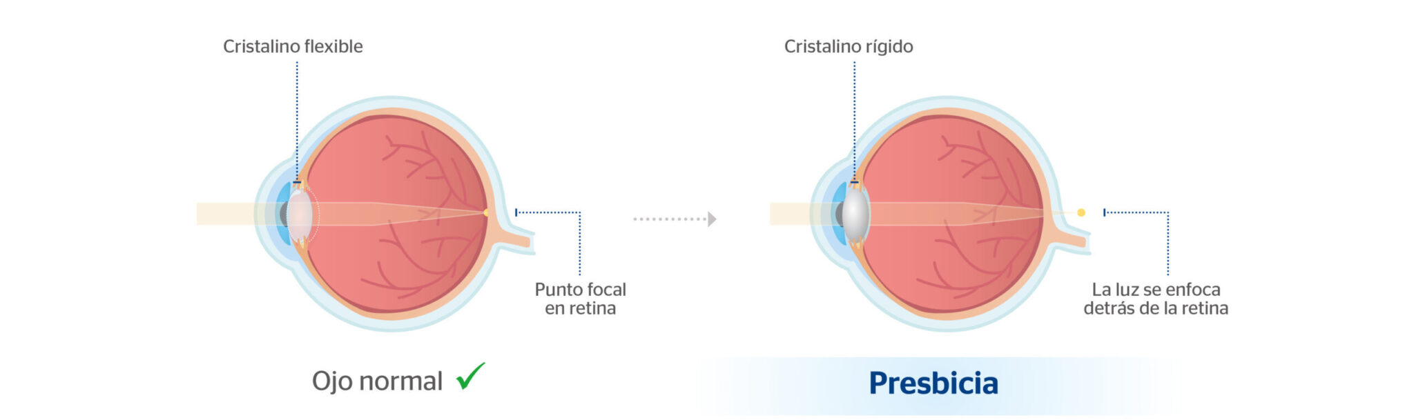 Visión borrosa en un ojo (o en ambos): ¿las causas? | Blog de Clínica Baviera