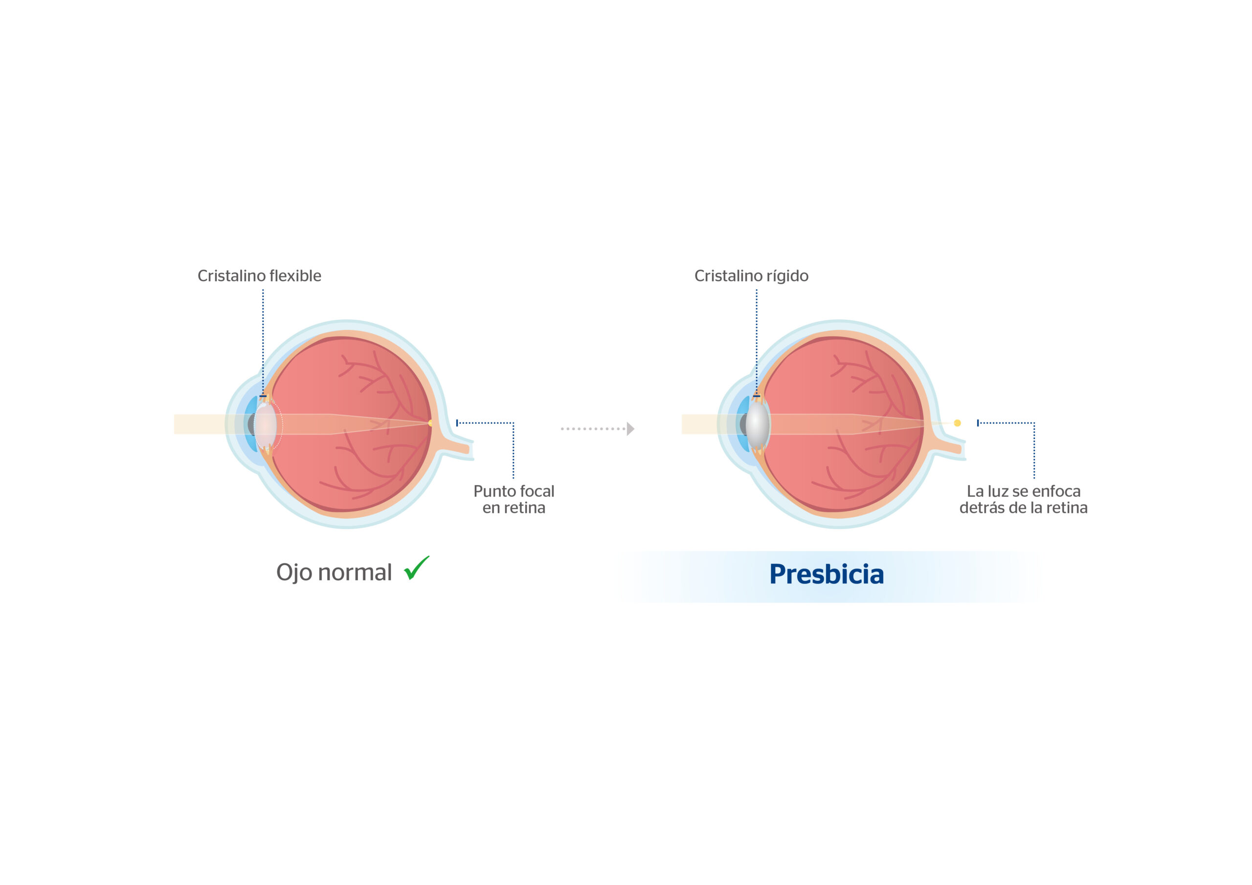 Descubre las diferencias entre hipermetropía y presbicia - Blog de ...