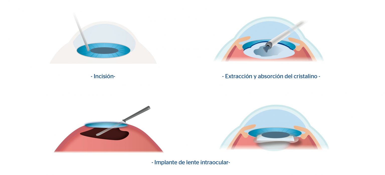Lentes intraoculares multifocales: ventajas y desventajas - Blog de ...