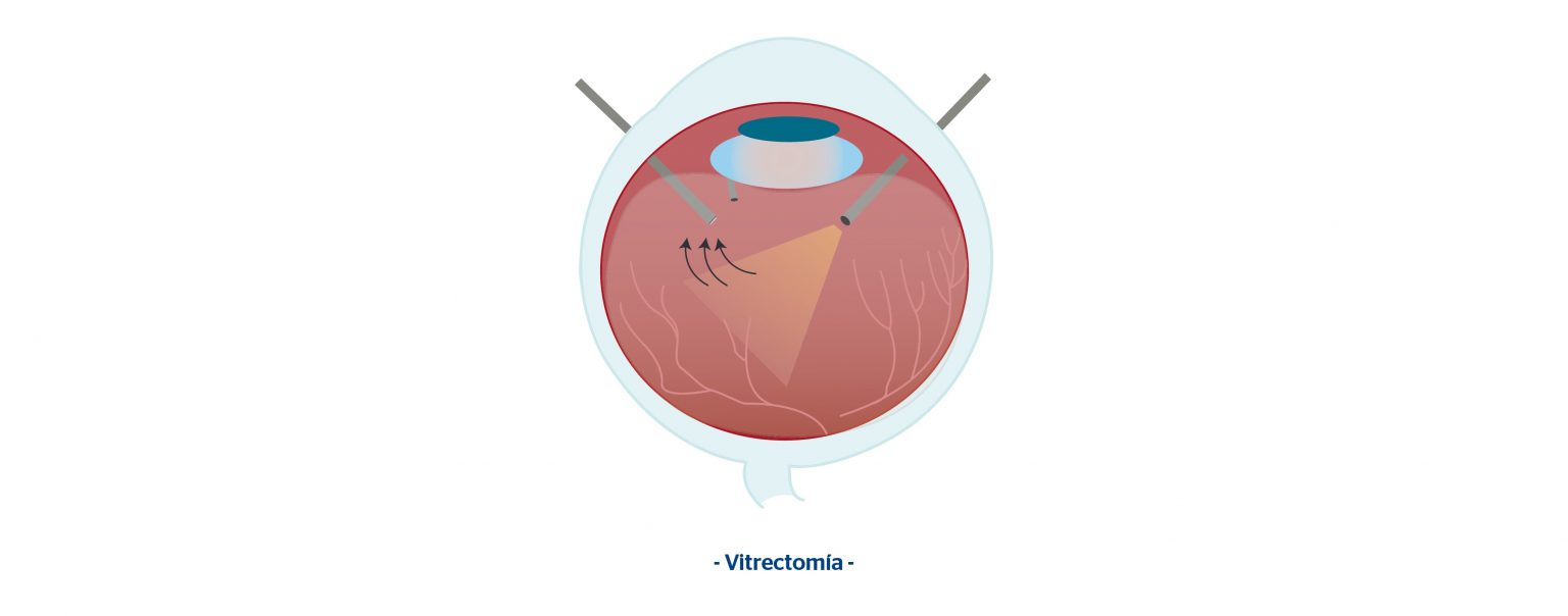 Retina: una parte fundamental del ojo - Blog de Clínica Baviera