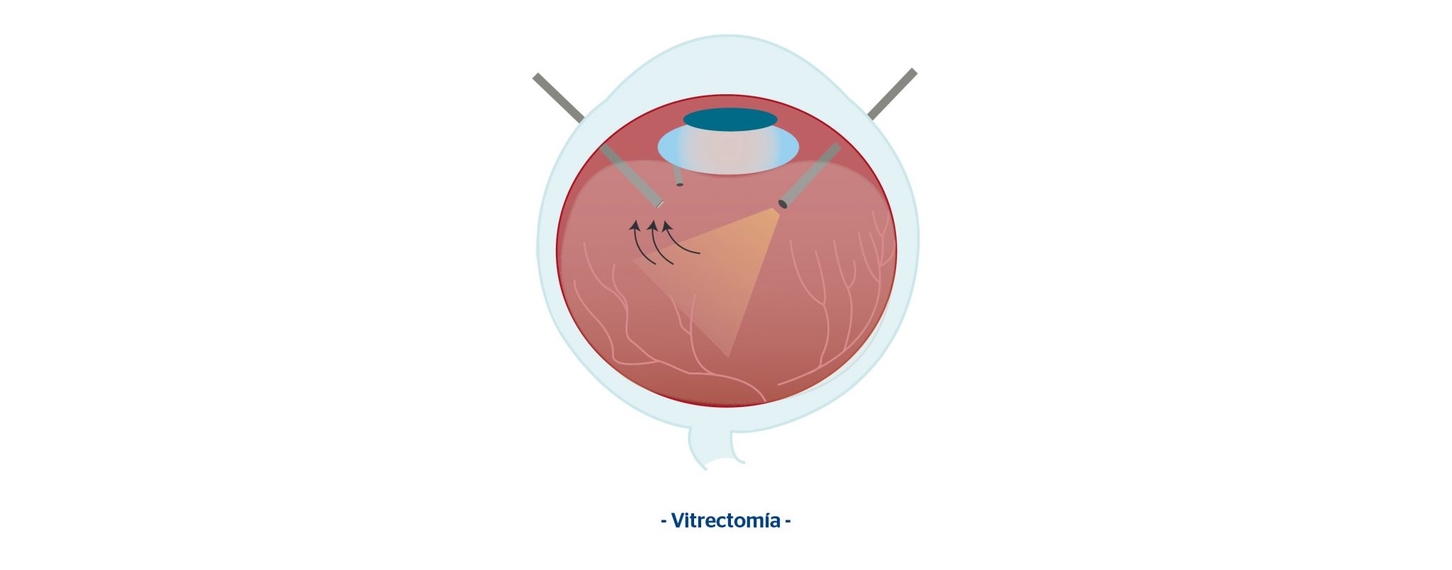 Hemorragia vítrea: qué es, síntomas, causas y tratamiento - Blog de ...