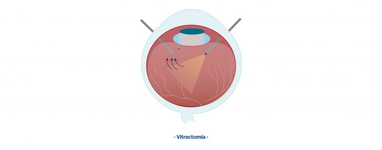 Hemorragia vítrea: qué es, síntomas, causas y tratamiento - Blog de ...