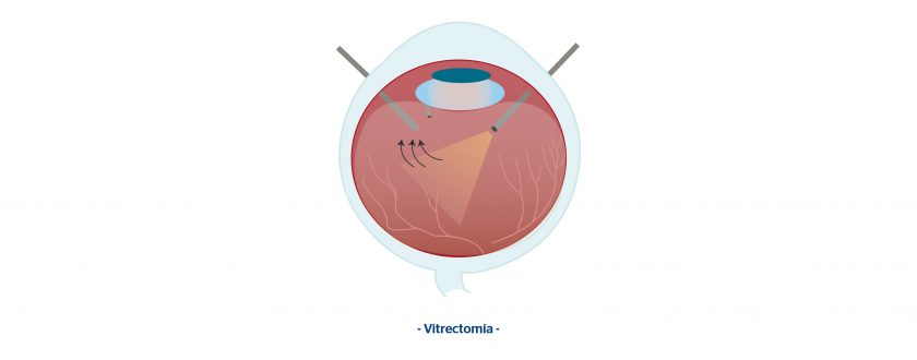 Miodesopsias o manchas negras en los ojos: ¿es grave?