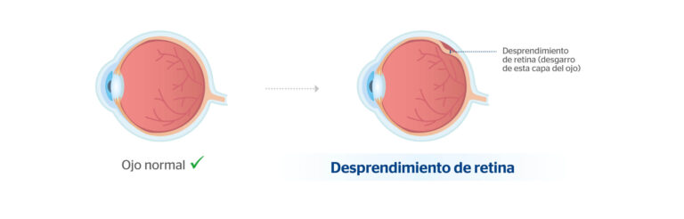Pérdida de visión en un ojo | Blog de Clínica Baviera