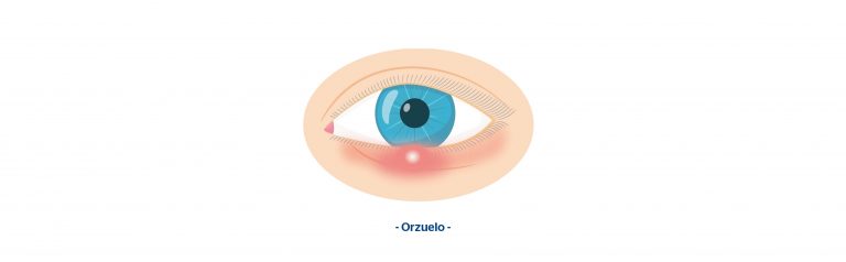 Edema Palpebral: causas y tratamiento | Blog de Baviera