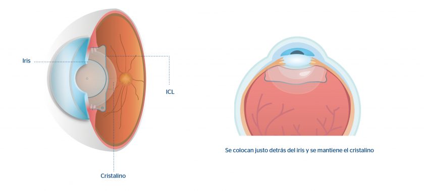 Operación De Miopía ¿cuál Es La Edad Recomendada Blog De Clínica
