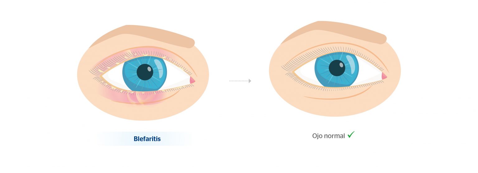 Ojos rojos: causas y soluciones - Blog de Clínica Baviera