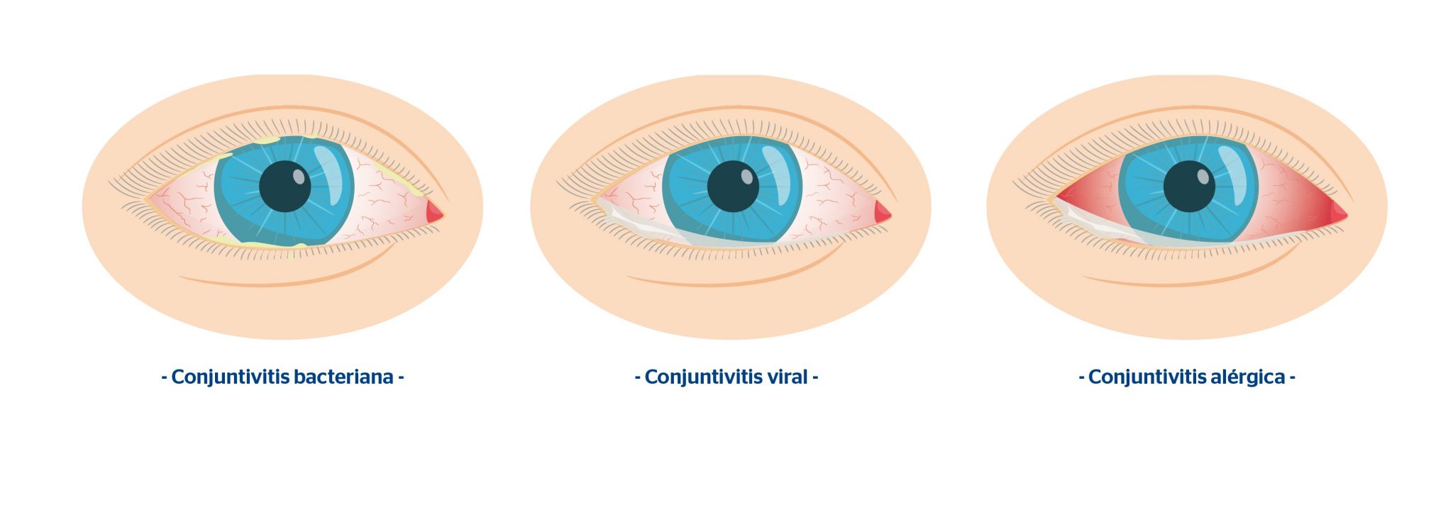 Conjuntivitis aguda: qué es y cuáles son los síntomas | Blog de Clínica ...