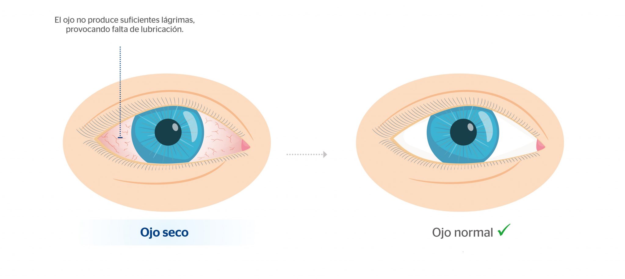 Visión borrosa en un ojo (o en ambos): ¿las causas? | Blog de Clínica Baviera