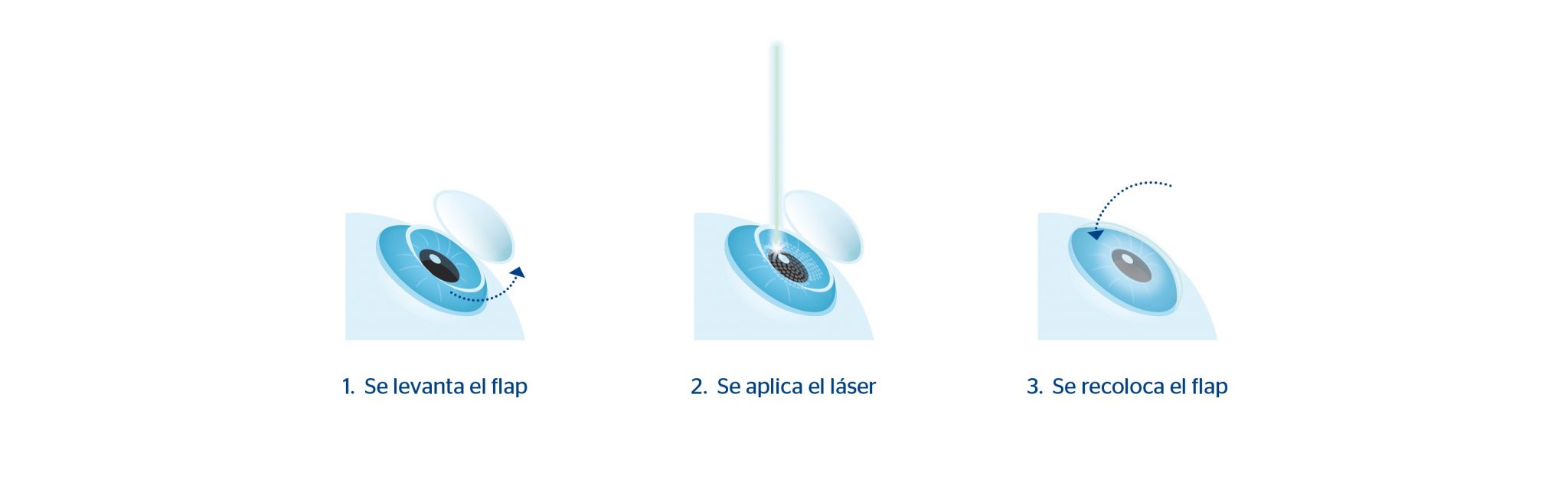 Operación de la vista: todo lo que tienes que saber al respecto - Blog ...